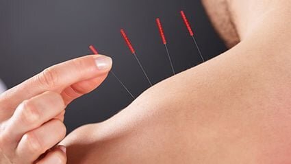 Acupuncture leads to improvement in motor aphasia after stroke - The ...